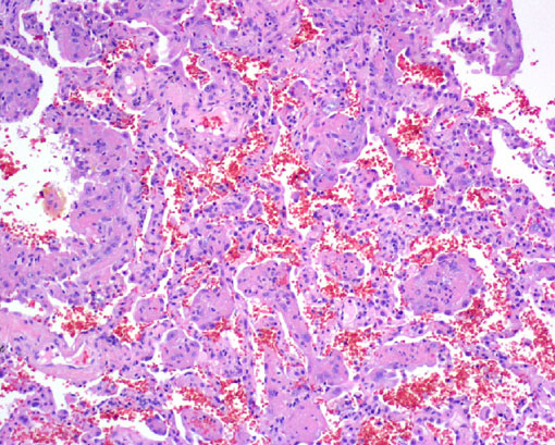 12/05/03 - Insuficiencia respiratoria subaguda con patrón reticular ...